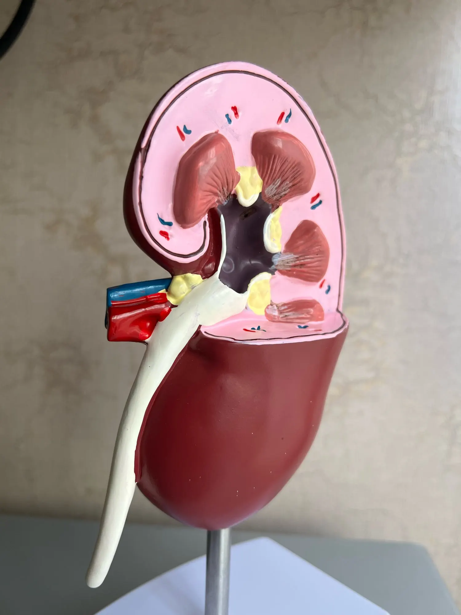3D Diseased Kidney Dissected Anatomy Model - Medical Arts Shop