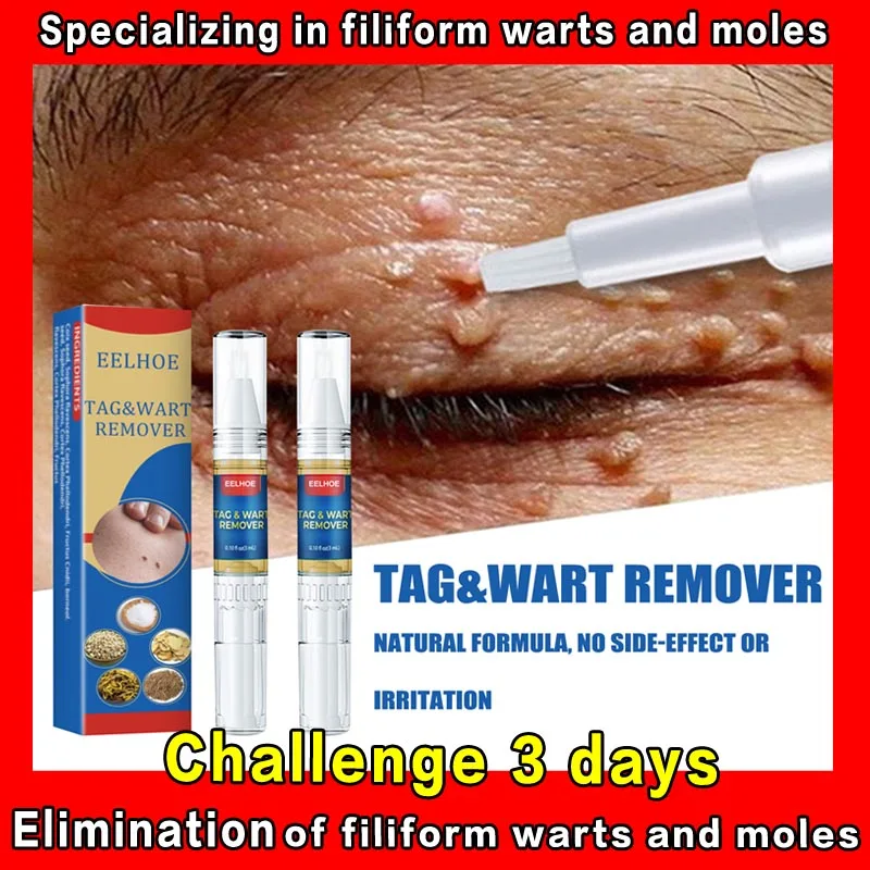 Mole-Removal-Pen-Genital-Herpes-Papilloma-Filiform-Treatment.jpg
