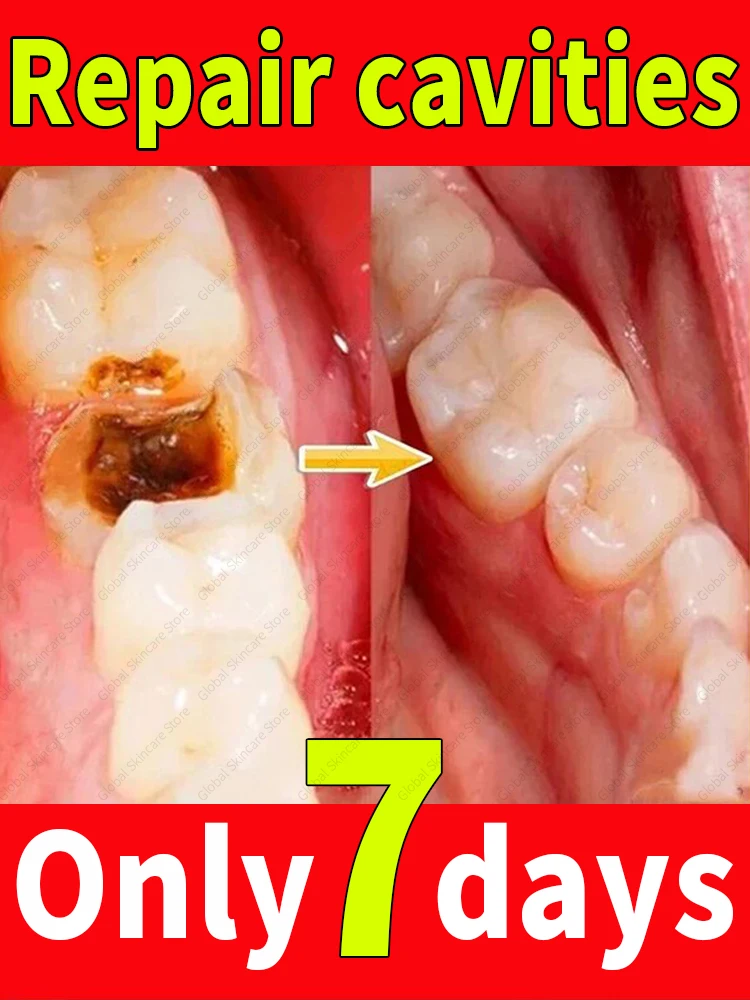 decay-Tooth-Repair-Repairing-Cavities-Protect-Anti-caries.jpg