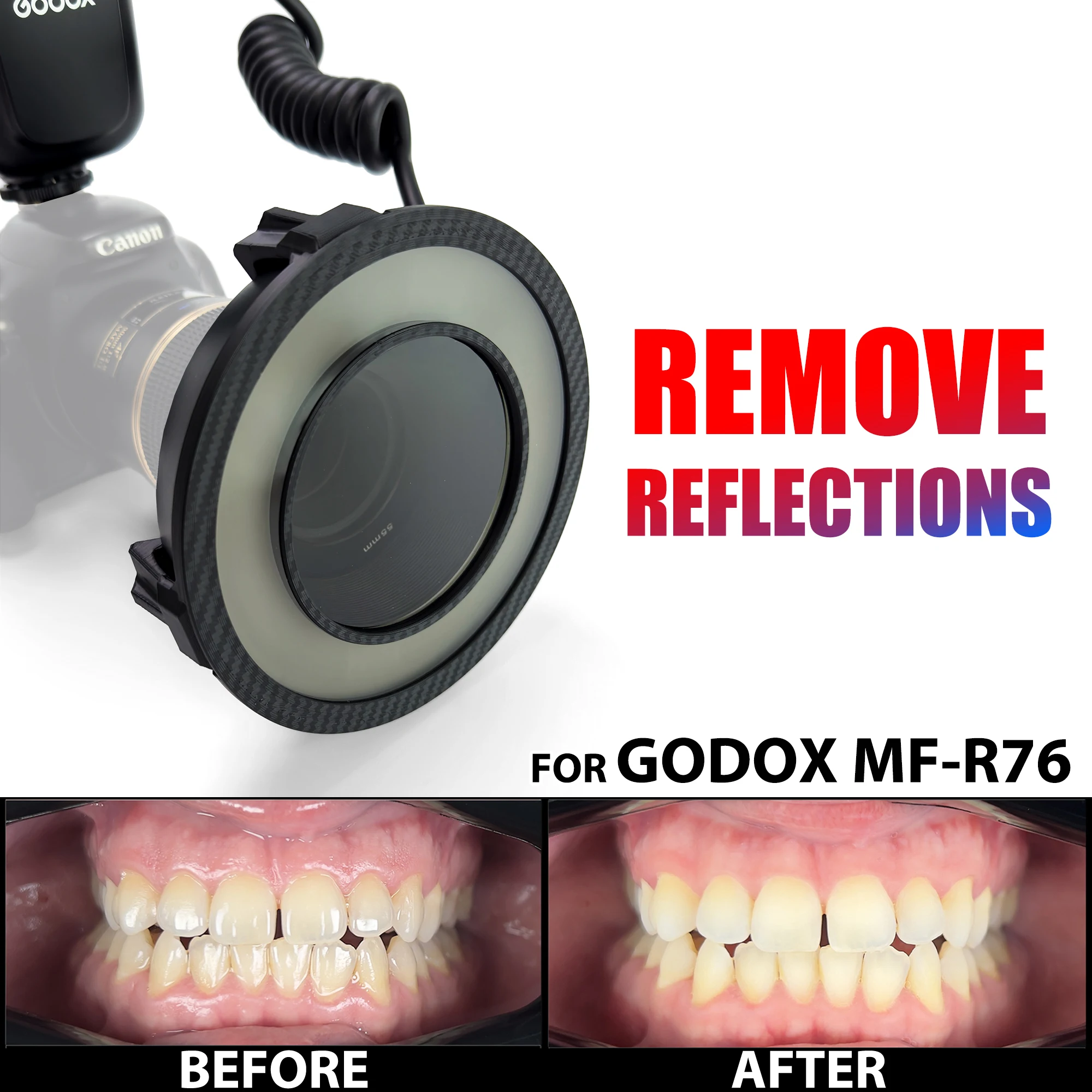 Dental Photo. Polarizing Filter For Godox MF-R76. No Reflections And No ...