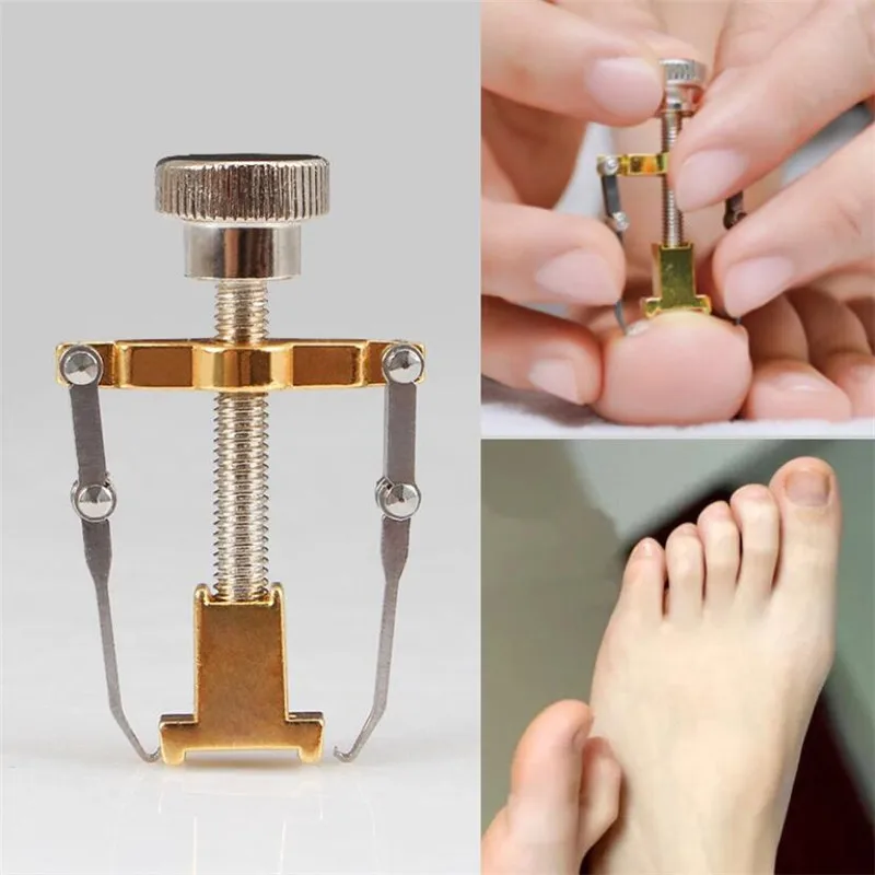 Ingrown Toenail Corrector Pedicure Toenail Fixer Foot Nail Care ...