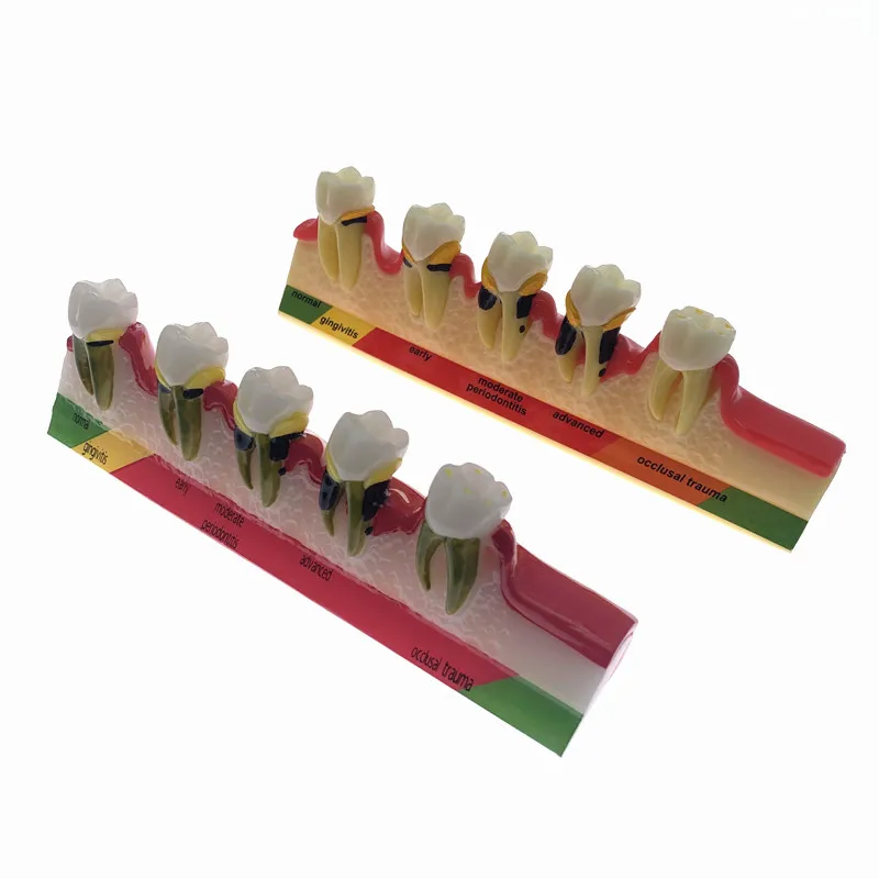 Dentist-Odontologia-Periodontal-Disease-Dental-Teeth-Model-Tooth-dental ...