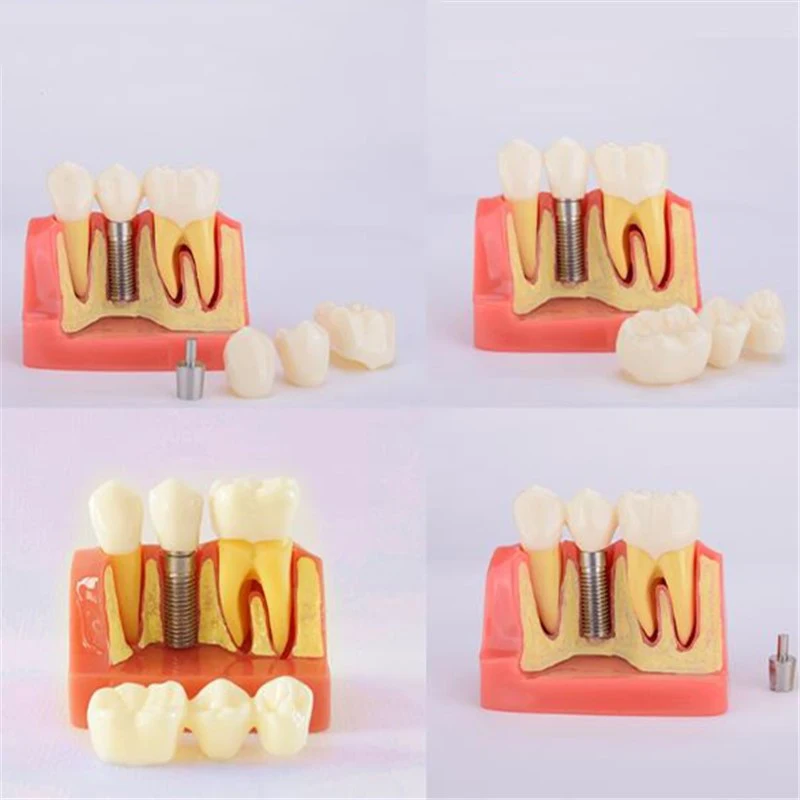 Dental-Teeth-Model-Dental-Teach-Implant-Analysis-Crown-Bridge ...