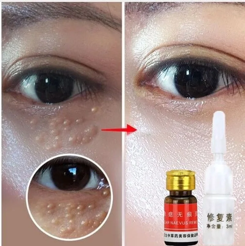 Solución indolora para eliminar lunares y pecas, crema para eliminar manchas oscuras, verrugas ...
