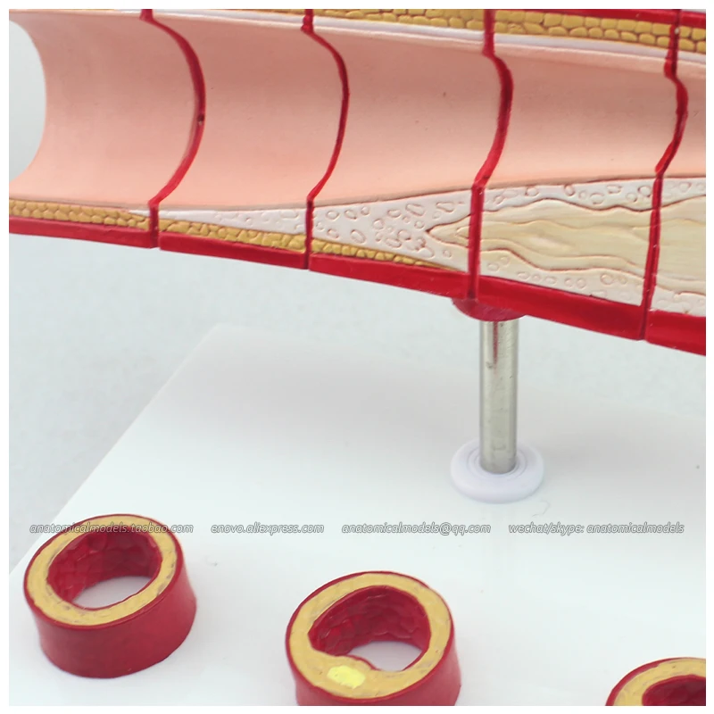 12484 / Artery w Plaque Buildup Anatomy Study Model, Medical Science ...