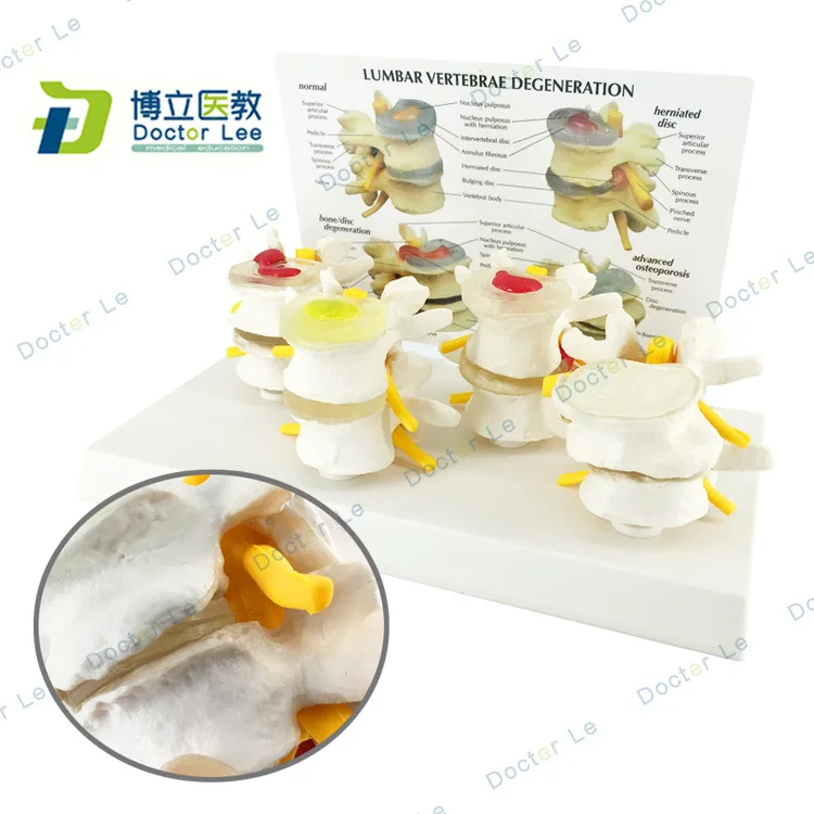 Human-1-1-Life-Sized-Lumbar-Spine-Normal-Lesion-Combination-Anatomy ...