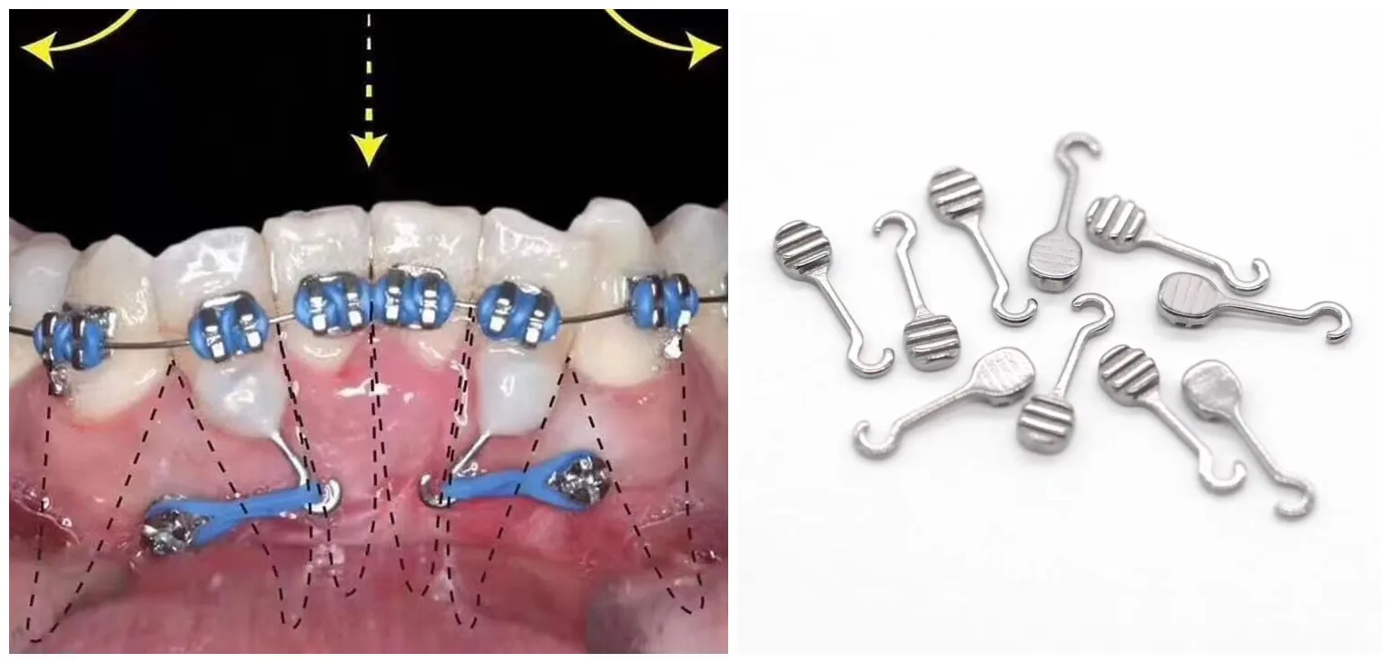 Monoblock Orthodontic Questions Crimpable Hook Bonding Adhesive Dental ...