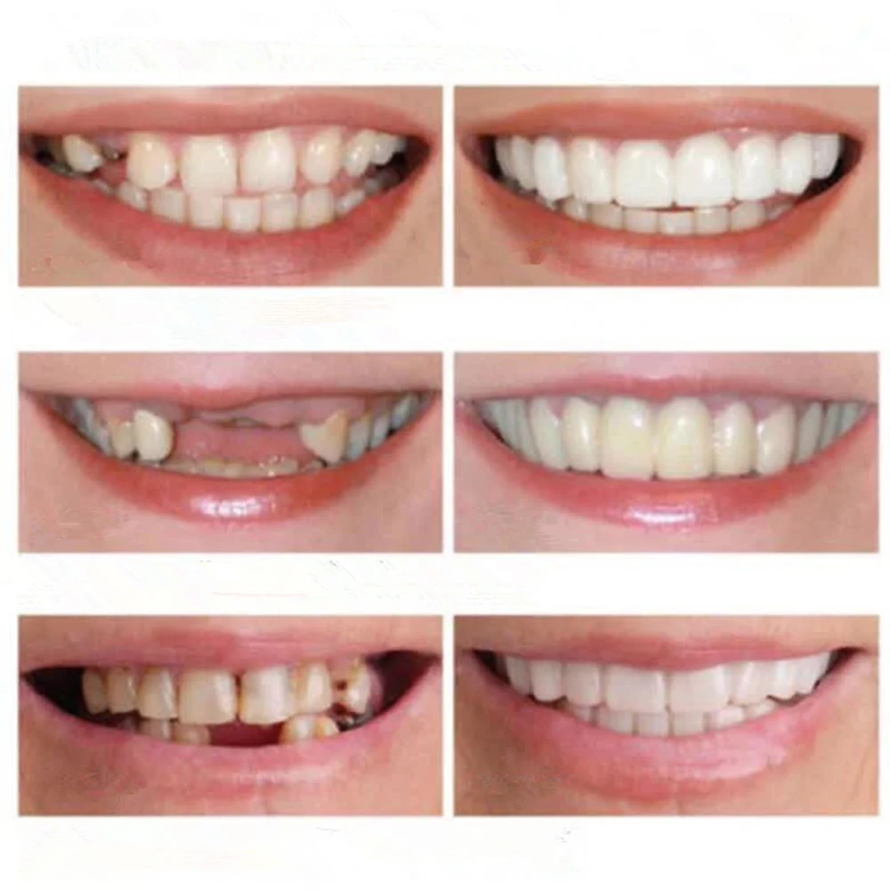 Prótese De Silicone Dente - RETOEDU