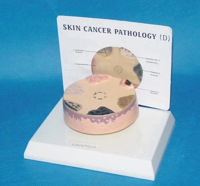 Human-Skin-Cancer-Pathology-Enlarged-Anatomical-Model-Medical-Teaching ...