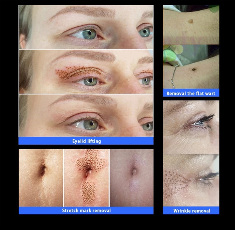 Filiform Wart Eyelid