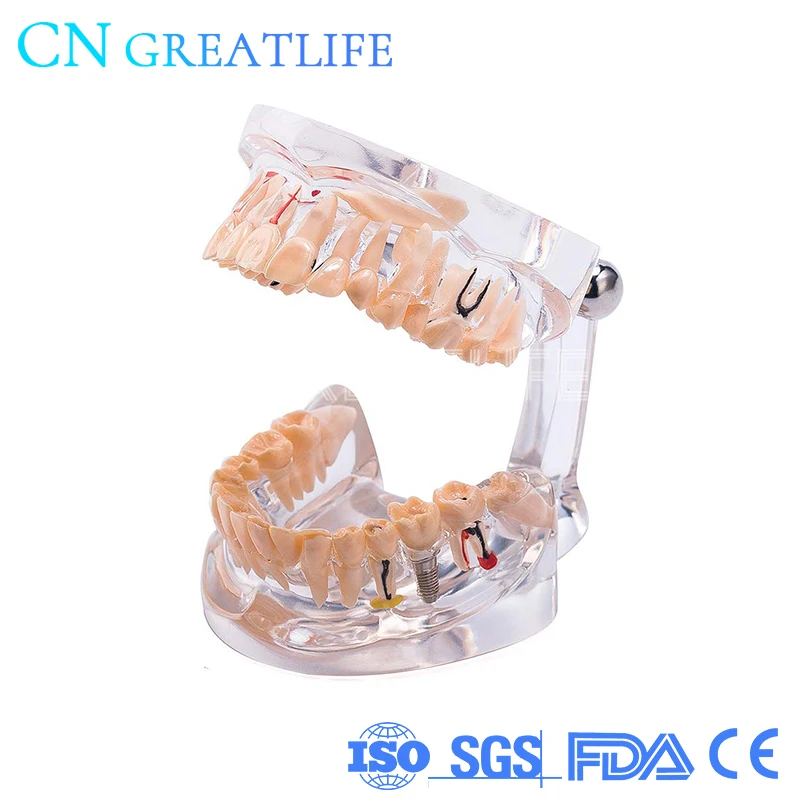 Dental-Pathology-Study-Analysis-Dental-Teeth-Model-Root-Canal-Typodont ...