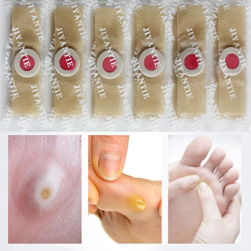 30pcs Corn Plaster Canopy Patch Medical Adhesive Plaster Corn Patch ...