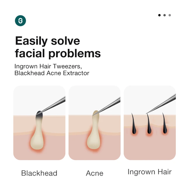 Blackheads Removal Tips