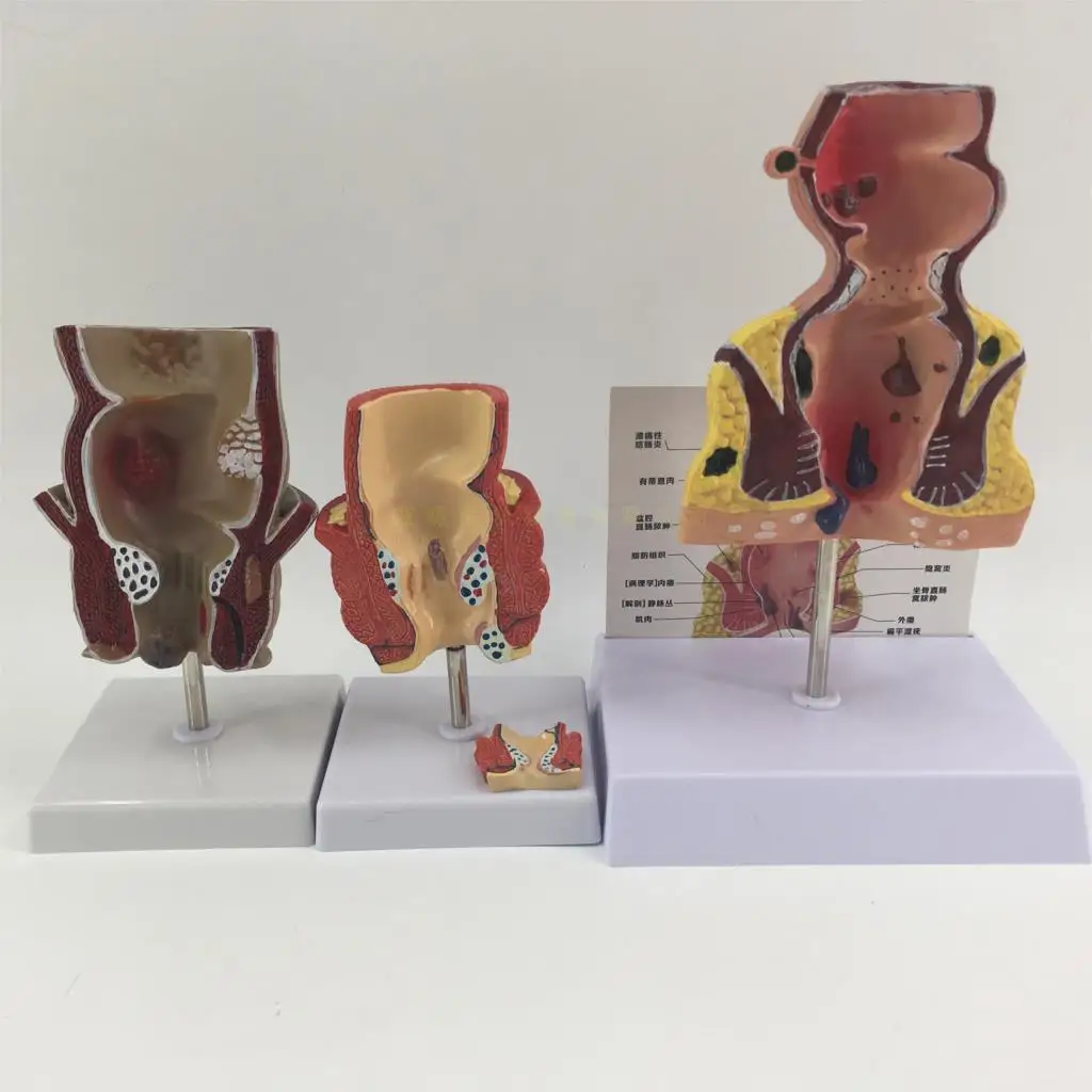 Modelo de hemorroidas interna/externa, modelo de patologia anorretal ...