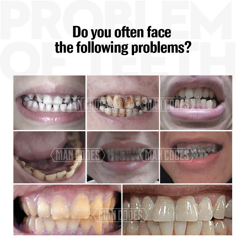 different types of teeth stains
