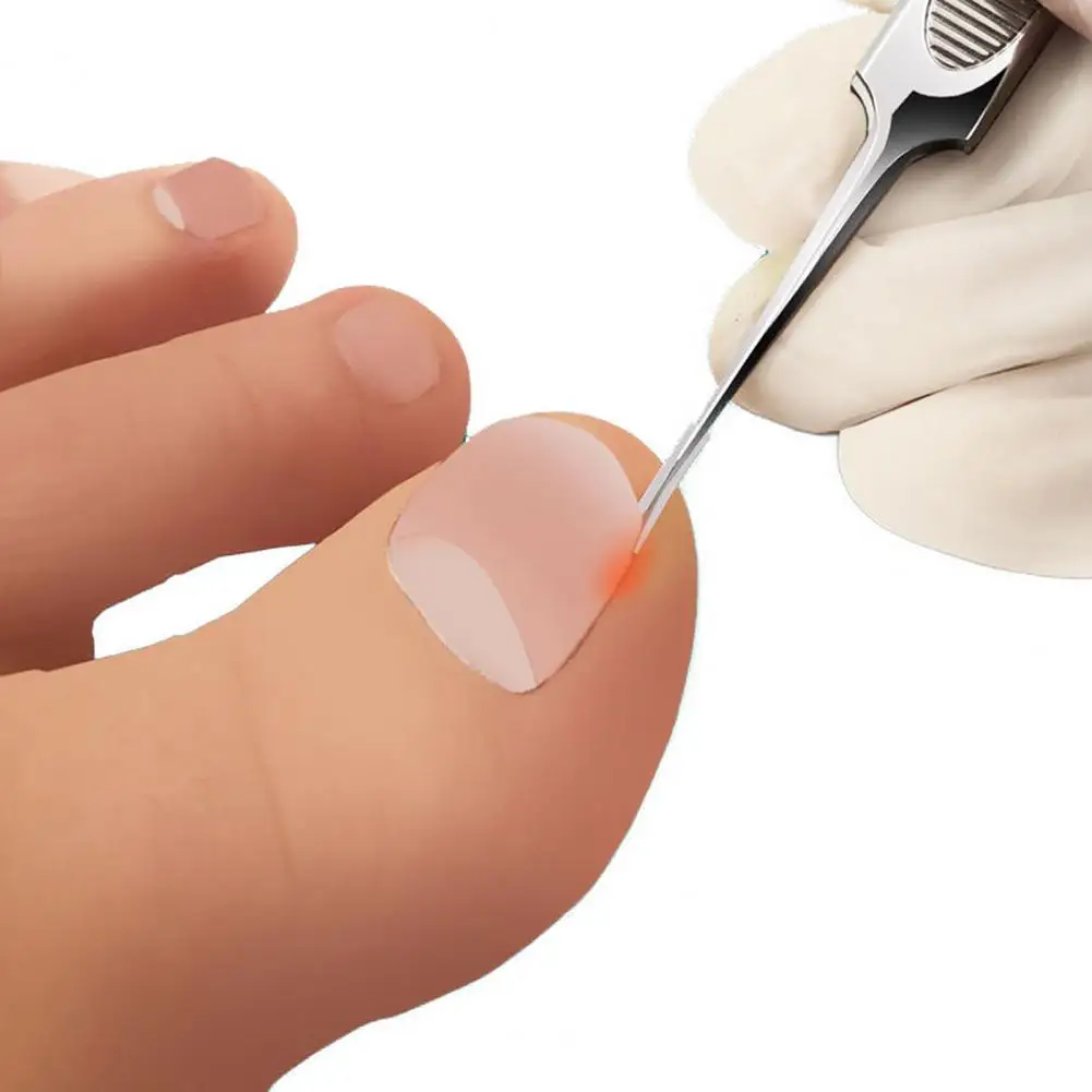 Ingrown Fingernail Cuticle