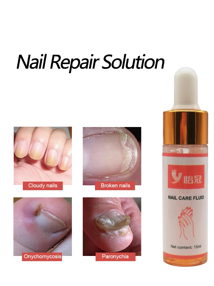 Nail Repair Solution Treatment Onychomycosis Paronychia Anti-fungal ...