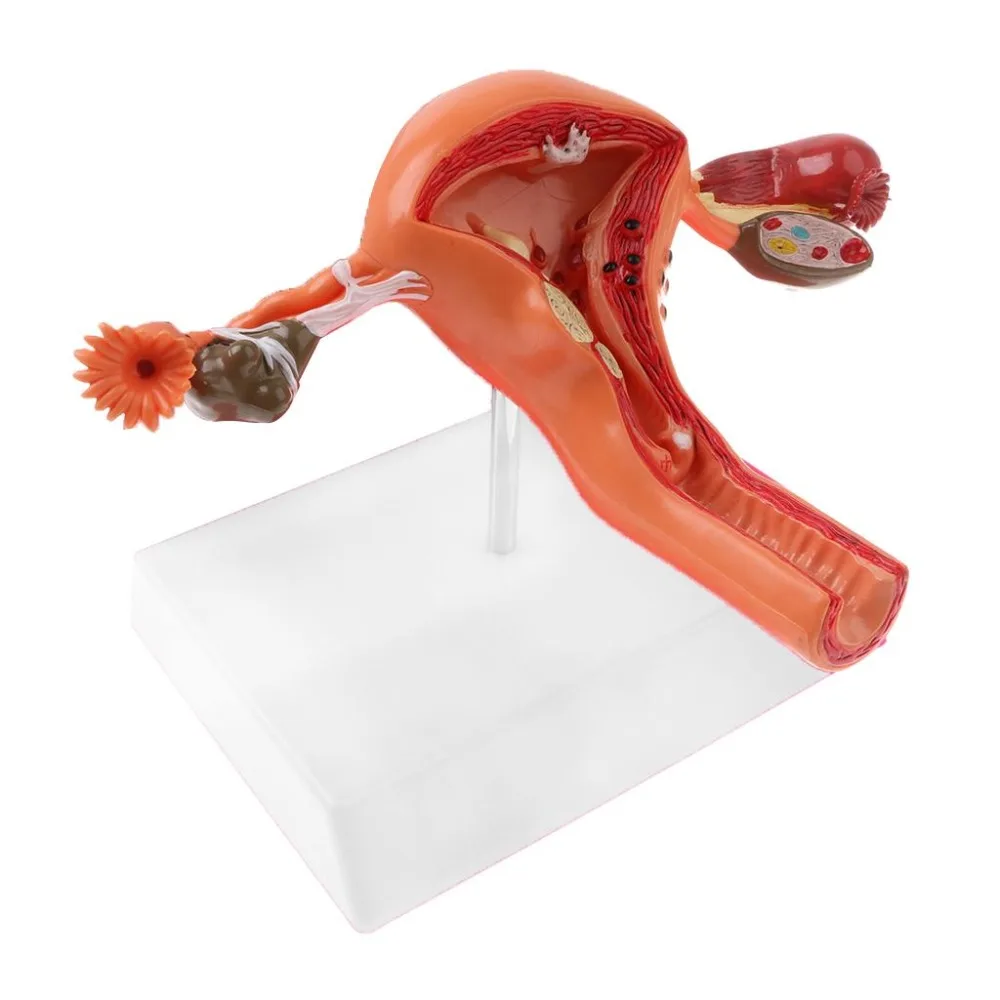 female Ovary and uterus disease Dissection model Pathology uterus model ...