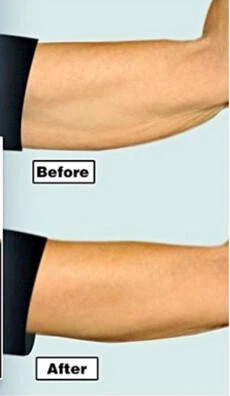 Opp Bag Pack Arm Slim Tape Makes Arms Look Firm And Younger Arm Shaping ...