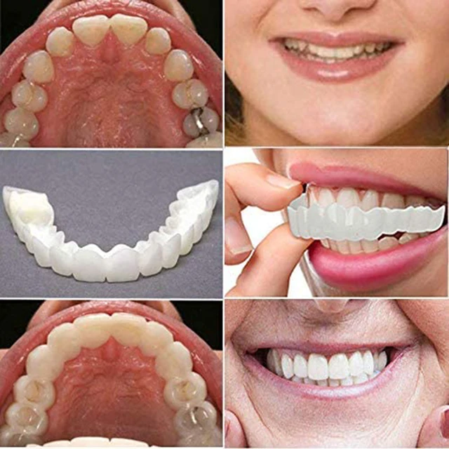 Snap On Smile Veneers (Upper & Lower Teeth Veneer) Perfect Instant ...