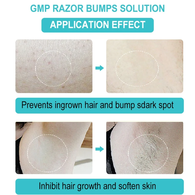 Razor Bump Diagram