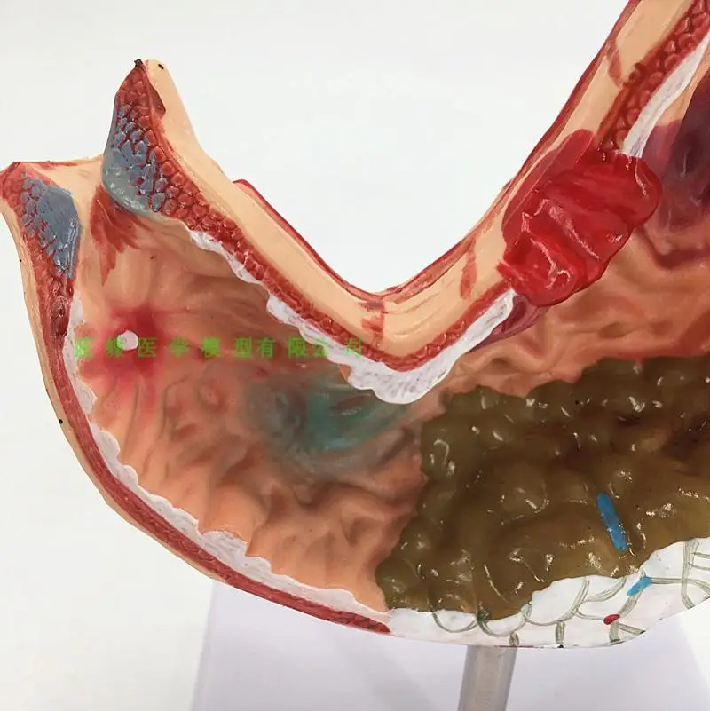 Diseased Stomach Model with Diaphragm Demonstration Model Pathological ...