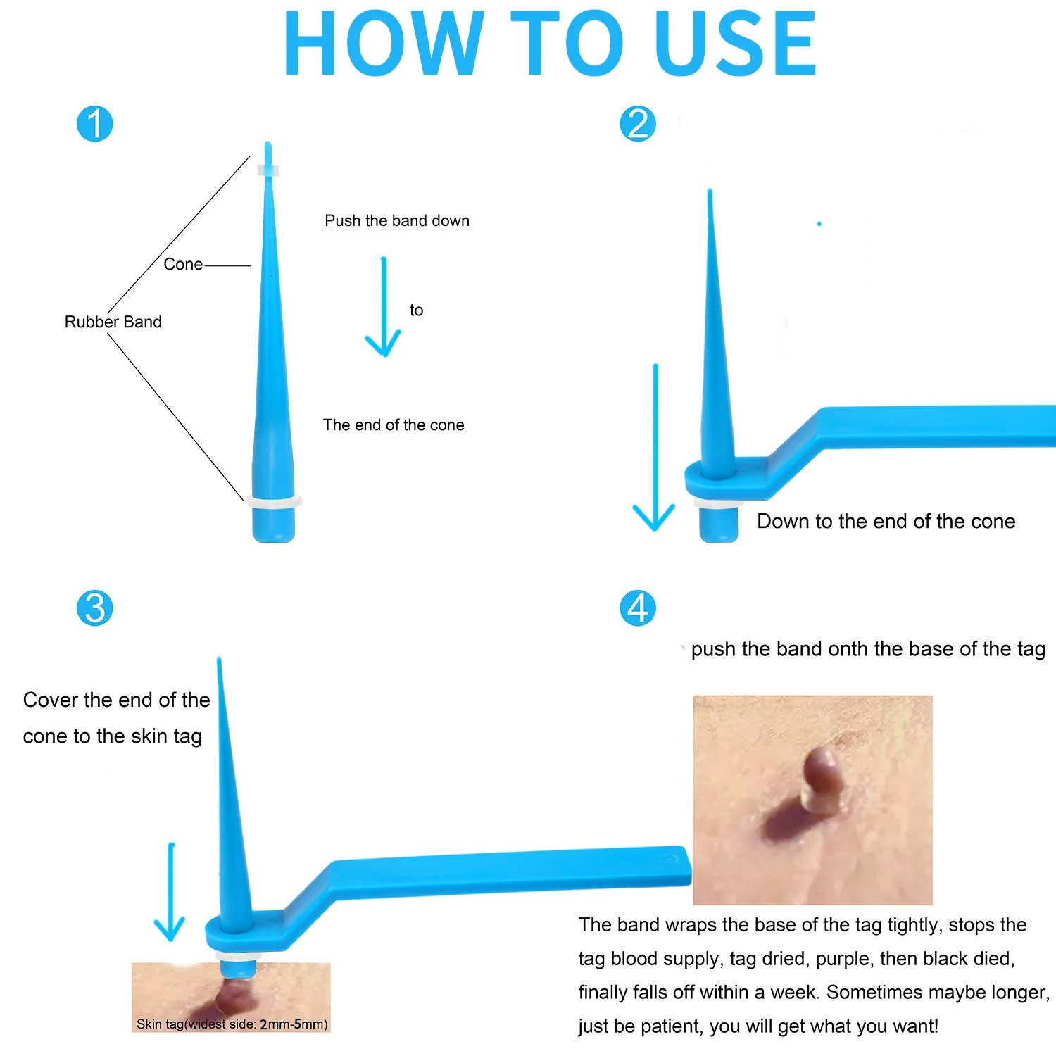 Shop Generic 1 Set Medical Skin Tag Kill Mole Wart Remover Micro Band ...