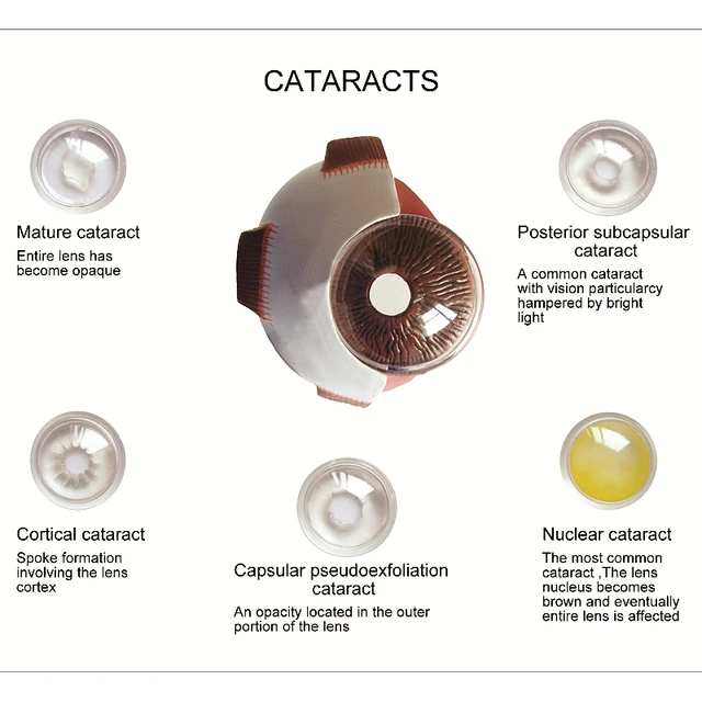 4X Human PVC Eye Cataract Anatomy Teaching Model_ - Alisa Mobile