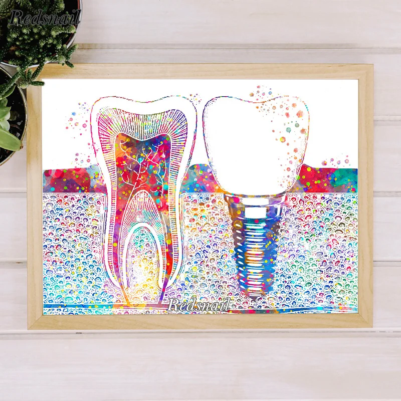 Tooth Implant Dentist Gift Dental Clinic Wall Decor Diy Diamond ...