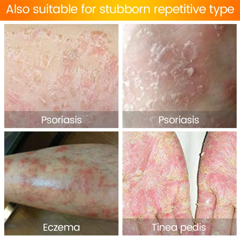 Vulvar Dermatitis Rash Discounts Deals | clc.cet.edu