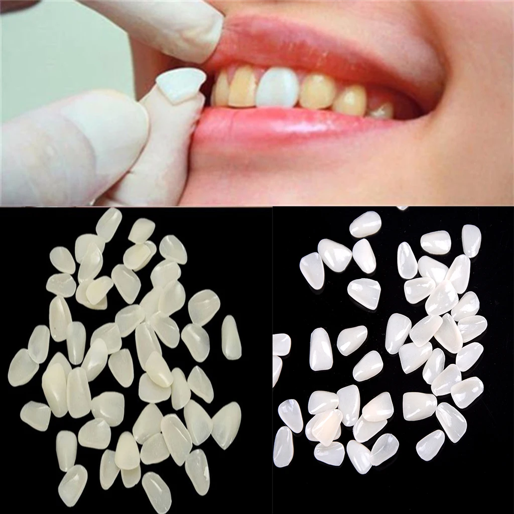 Teeth-Veneers-Resin-Temporary-Crown-Ultra-Thin-Dental-Oral-Care-Dentist ...