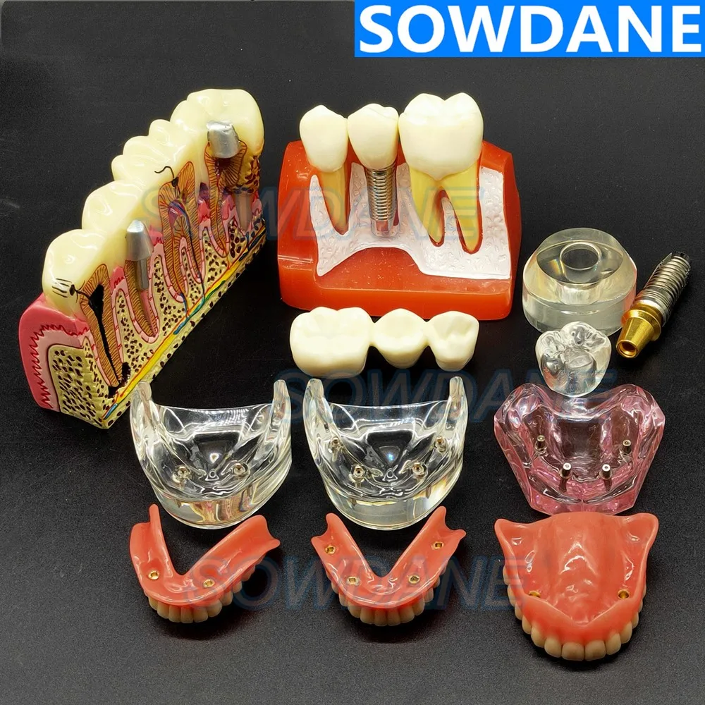 Dental-Implant-Demonstration-Model-Teeth-Study-Teach-Model-Disease ...