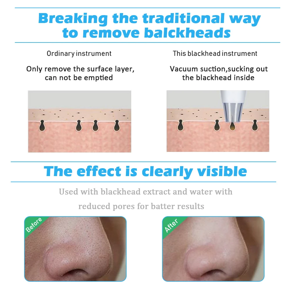 Microdermabrasion Blackheads Before And After