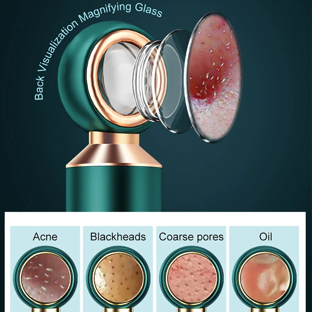 Blackheads Magnified