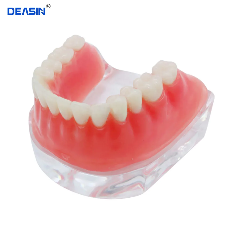 Mandibular Partial Denture
