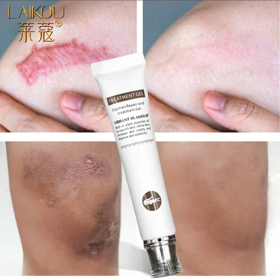 Laikou Striae Remover Huidverzorging Litteken Crème Van Striae Moederschap Behandeling Litteken ...