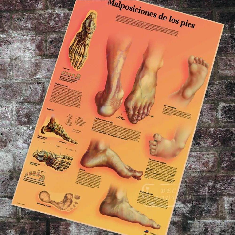 Anatomia-patologia-anat-mica-malposicionais-de-los-pinturas-cl-ssicas-em-tela-vintage-posteres ...