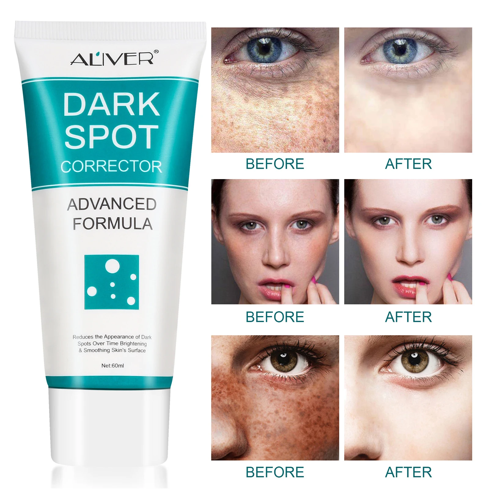 ALIVER crema correctora de manchas oscuras, crema blanqueadora para pecas, potente, elimina ...