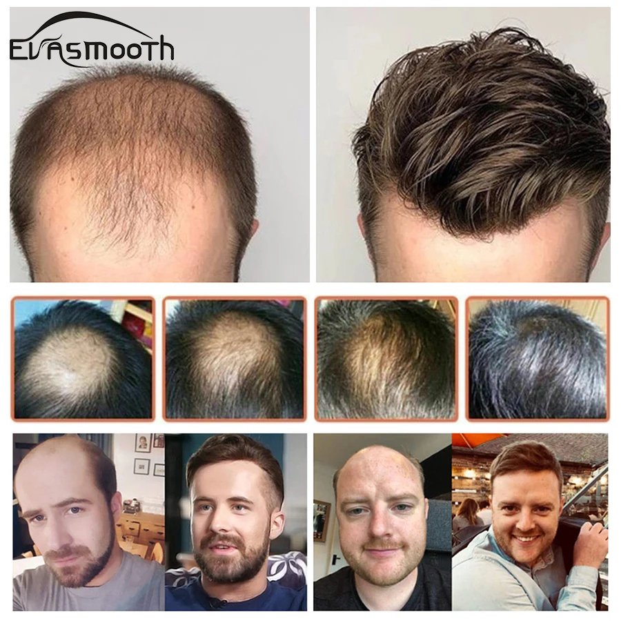 Toupee Before And After | ppgbbe.intranet.biologia.ufrj.br