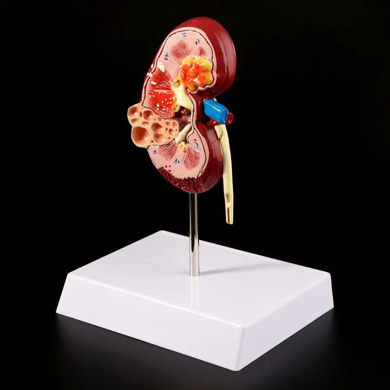 Life Size Kidney Diseased Model Pathological Change Anatomical Anatomy ...