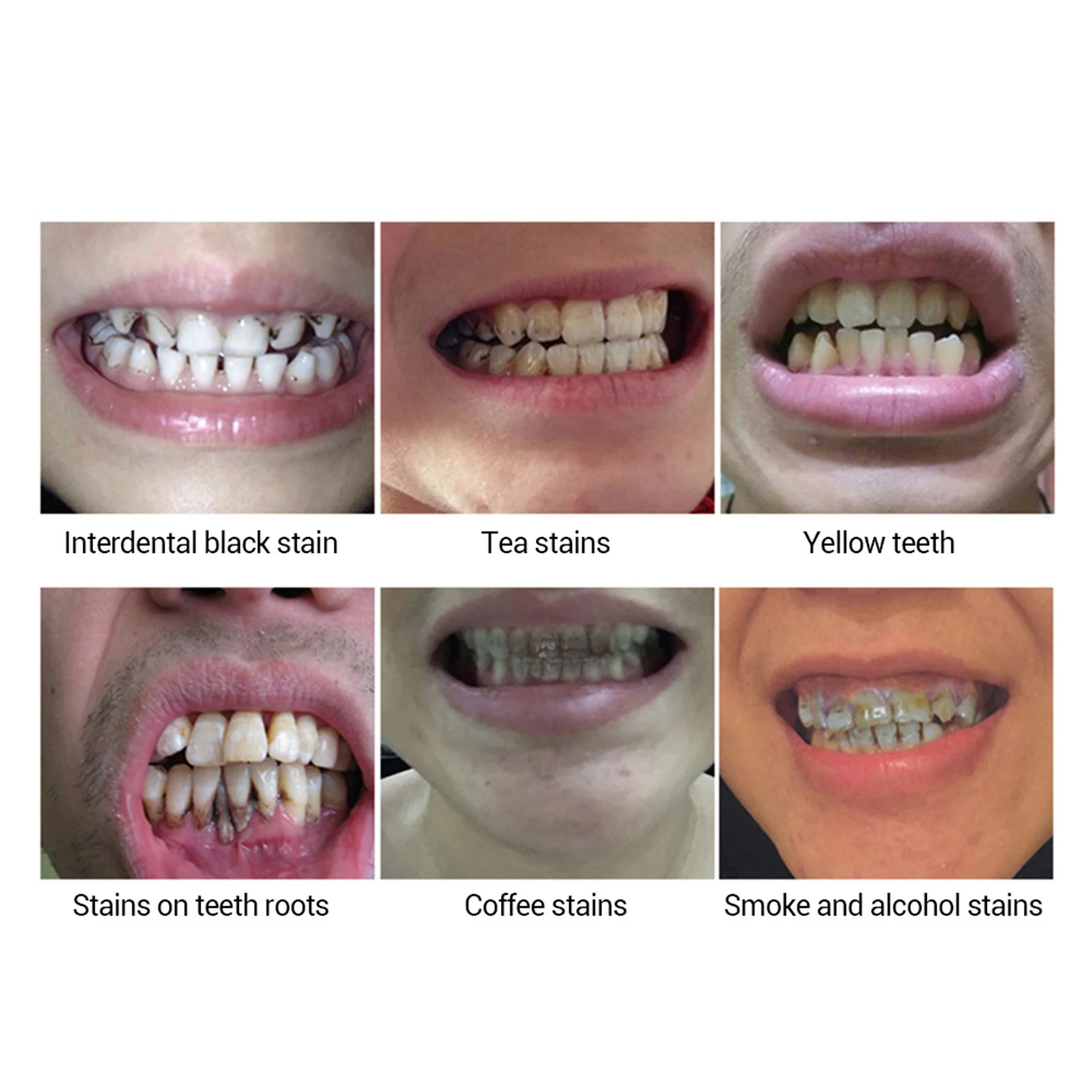 Coffee And Tea Stains On Teeth