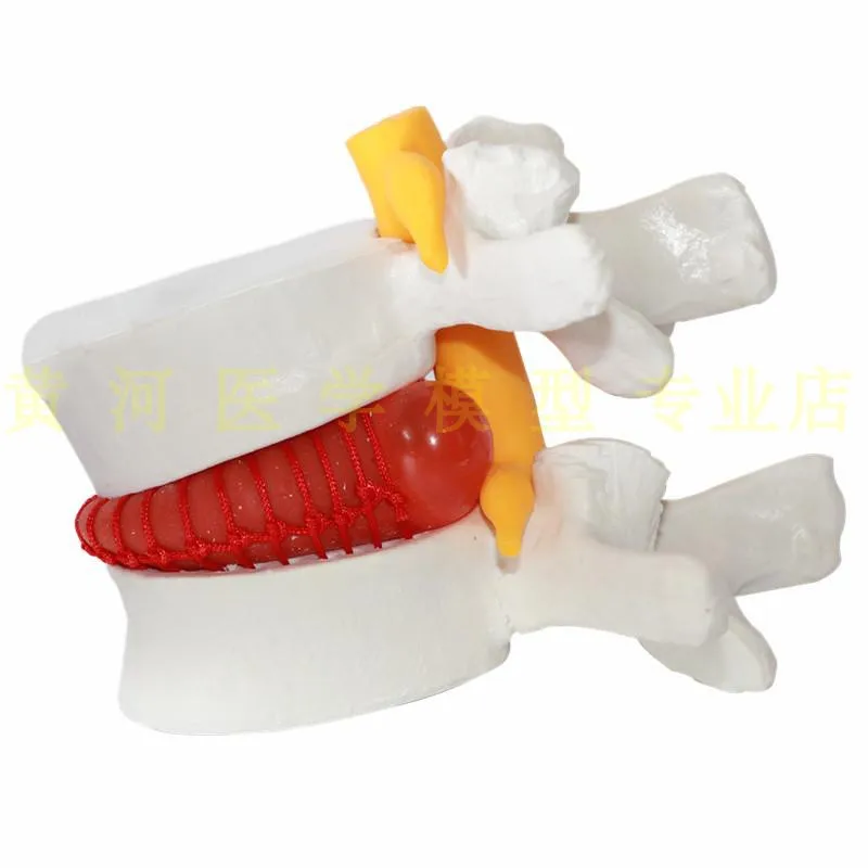 Human lumbar intervertebral disc demonstration model Lumbar spine model ...