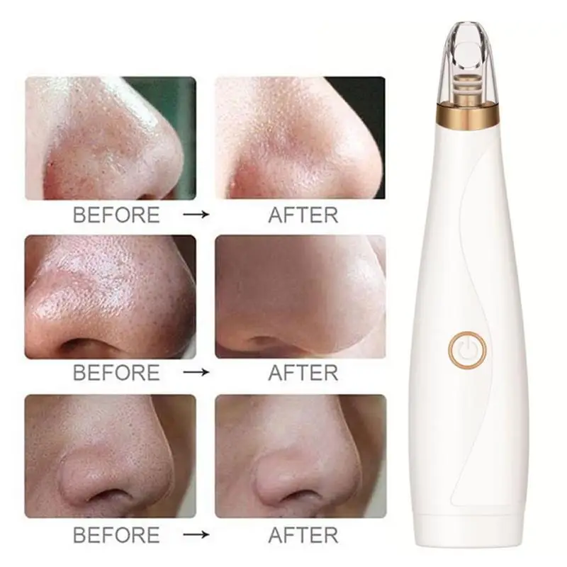 Blackhead Remover Face Deep Pore Cleaner Acne Pimple Removal Vacuum ...