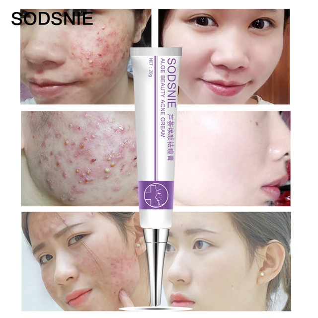 Aloe Acne Treatment Cream Pimple Acne Mark Blackhead Removal Moisturizing Oil Control Face Gel ...