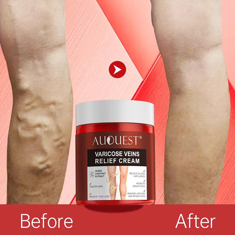 Auquest Varicose Veins Relief Cream Vasculitis Phlebitis Spider Pain ...