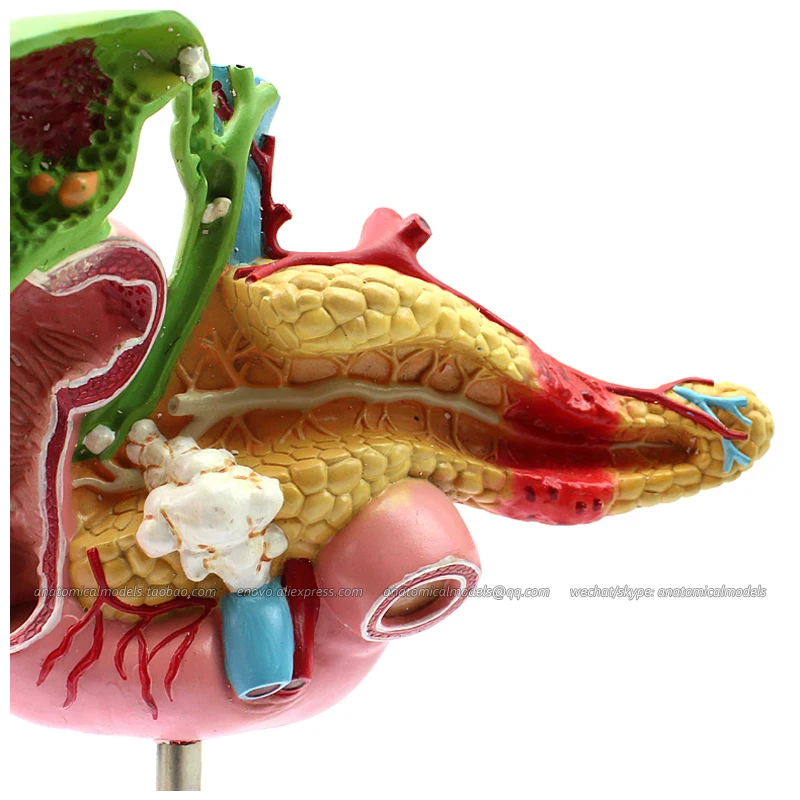 12541 / Pathological Model of Pancreas, Duodenum and Gallbladder ...