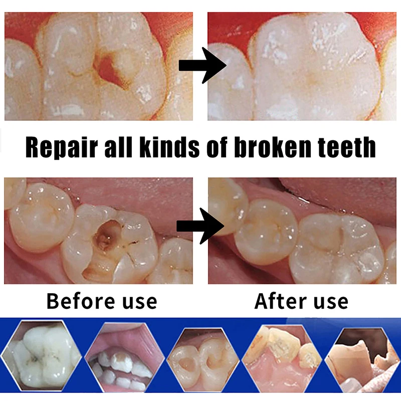 Colle à dentier pour fausses dents, Kit de réparation des interstices ...