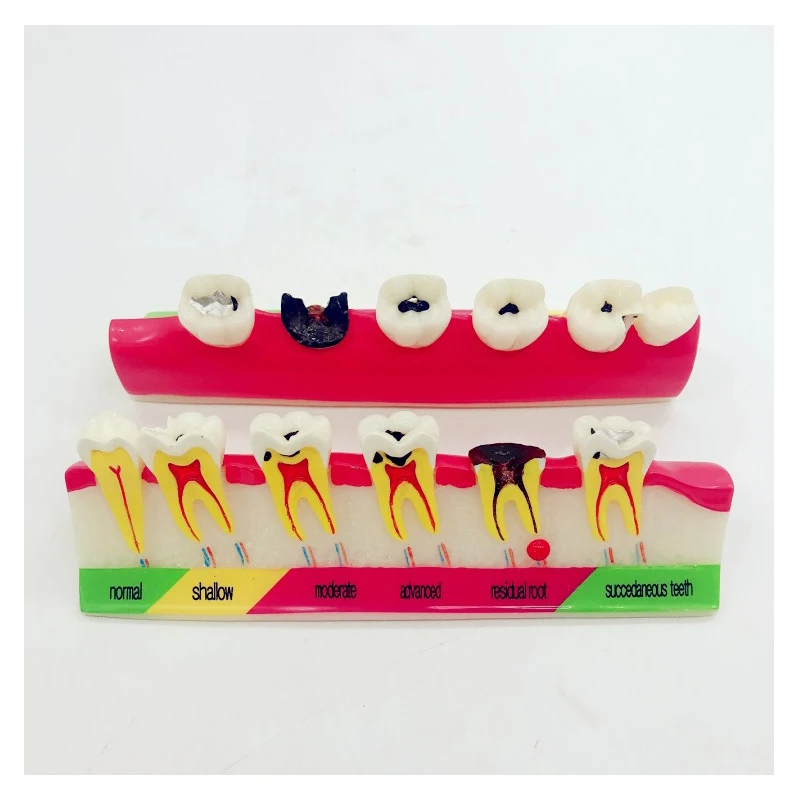 Dental-Oral-Teeth-Model-Periodontal-Disease-Model-M4011-Teeth-Pathology ...