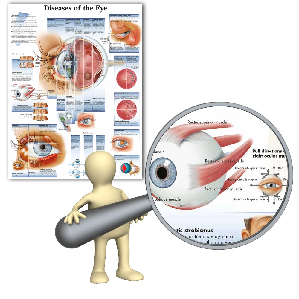 WANGART Poster Diseases of the Eye Chart Posters Refractiv Canvas print ...