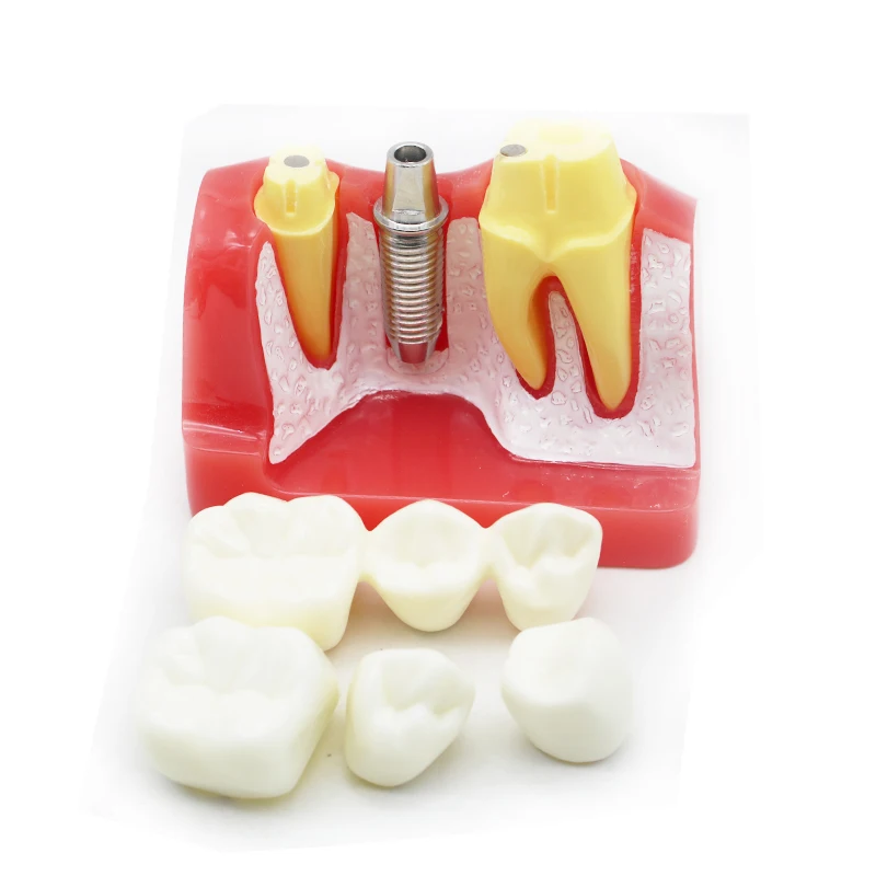Tooth model dental demonstration teeth Removable model implant analysis ...
